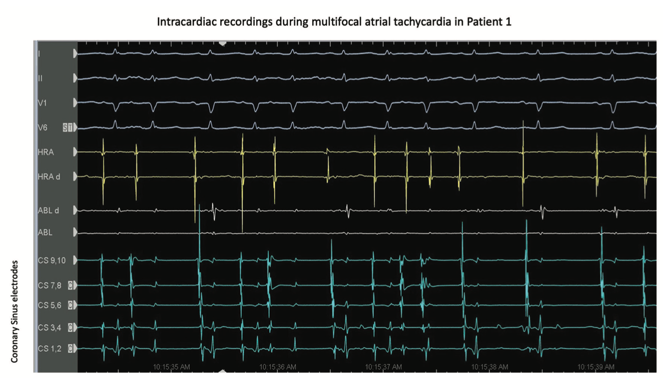Targeted Ablation Of Multifocal Atrial Tachycardia Ep Lab Digest